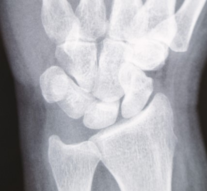 手首を曲げると痛いTFCC損傷の原因と治療法